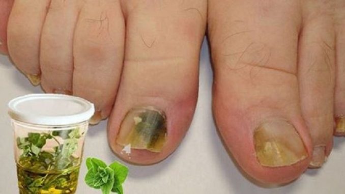 Livre-se dos fungos nas unhas de uma vez por todas com estas dicas ...