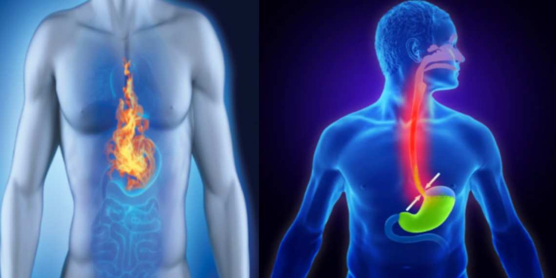 Diga adeus ao refluxo gástrico, que tanto prejudica sua saúde, de uma ...